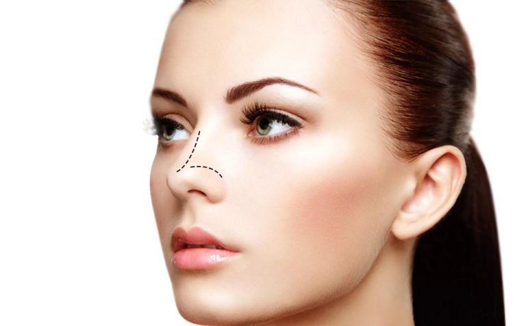 Descubre cuánto dura la rinomodelación con ácido hialurónico y obtén una nariz perfecta por más ...